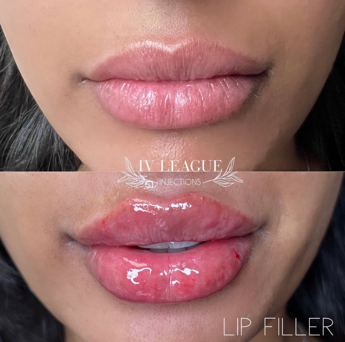 DERMAL FILLER – IV League Injections